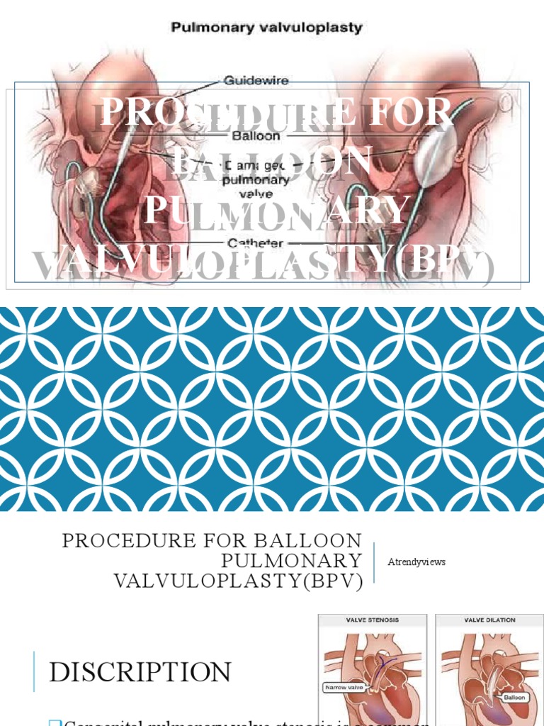Procedure For Ballon Pulmonary Valvuloplasty (BPV) | PDF | Catheter ...