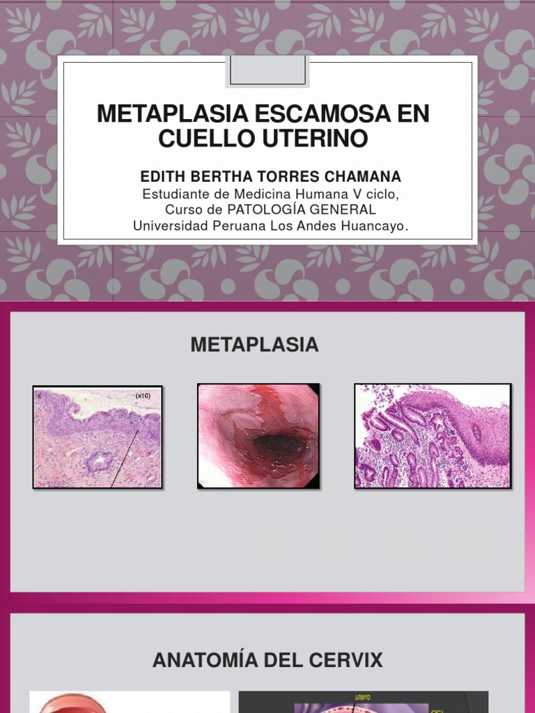 METAPLASIA Escamosa EN CUELLO UTERINO | PDF