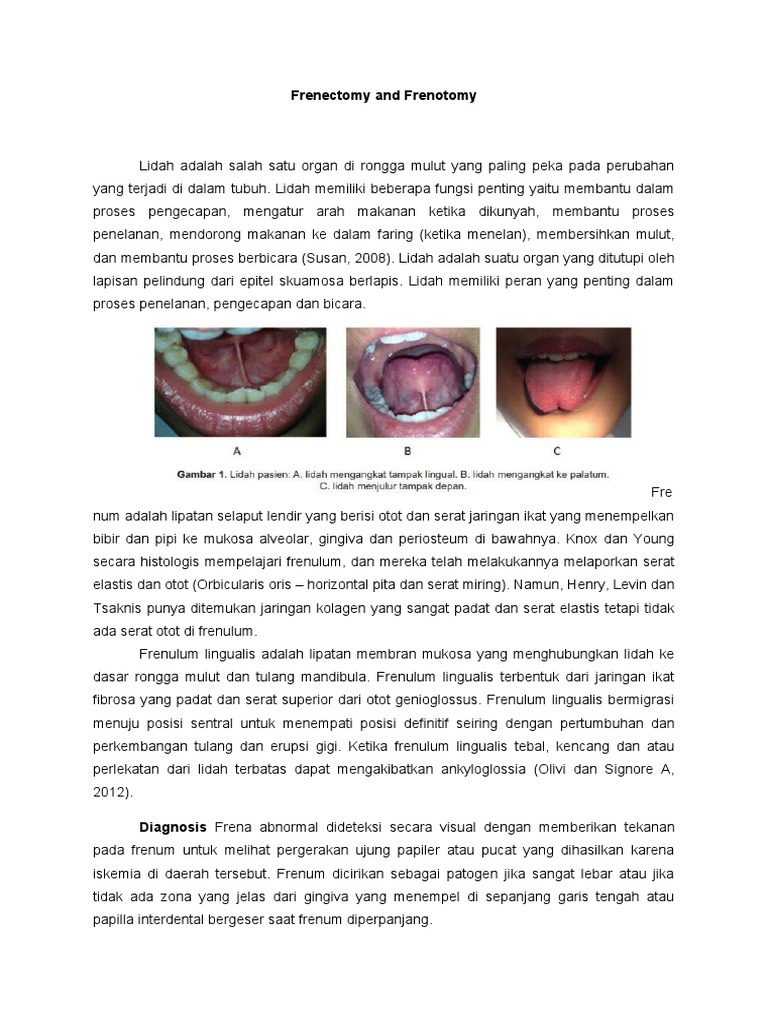 Frenektomi | PDF | Seni & Disiplin Bahasa | Kesehatan Holistik