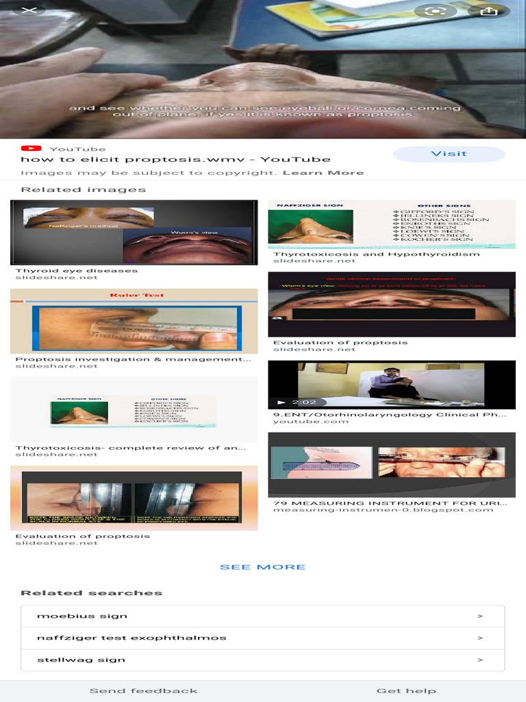 Naffziger Sign - Google Search | PDF