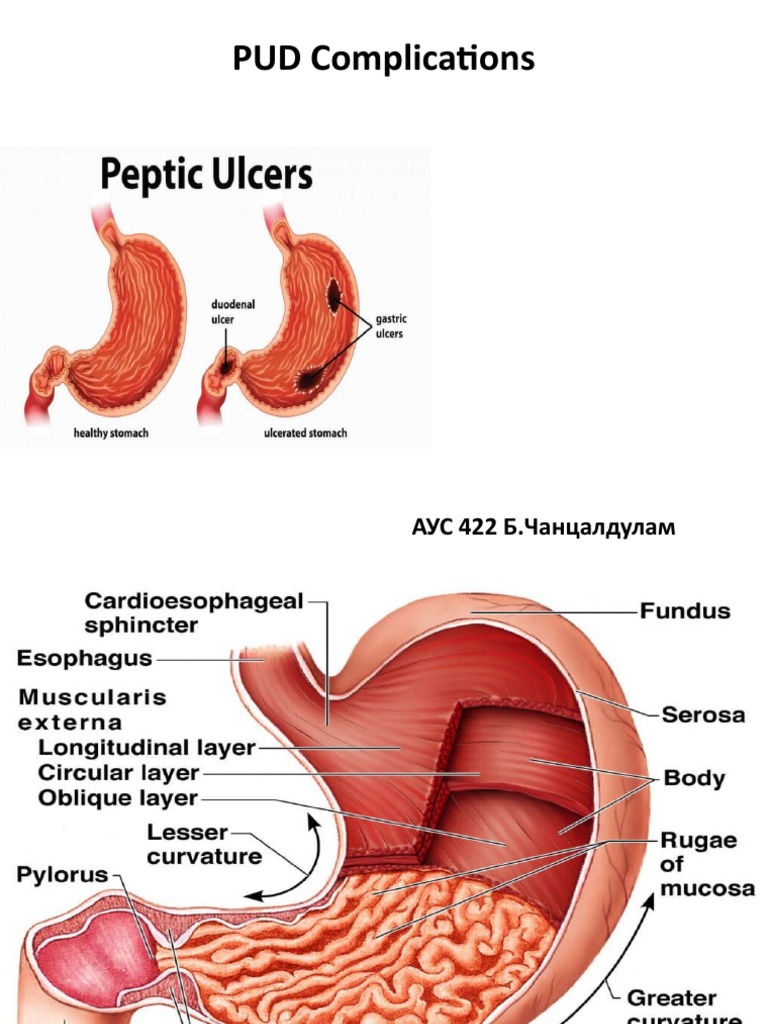 SDC SURGERY PUD COMPLICATIONS (Autosaved) (Autosaved) (Autosaved) (Autosaved) | PDF