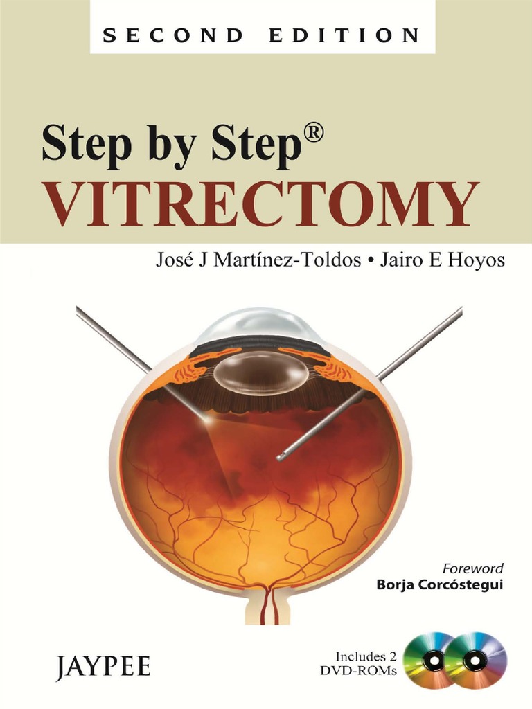 Step by Step VITRECTOMY PDF | PDF | Vision | Medicine