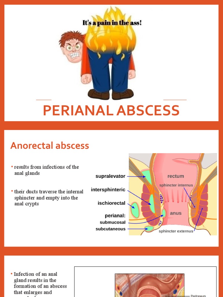 Perirectal Abscess