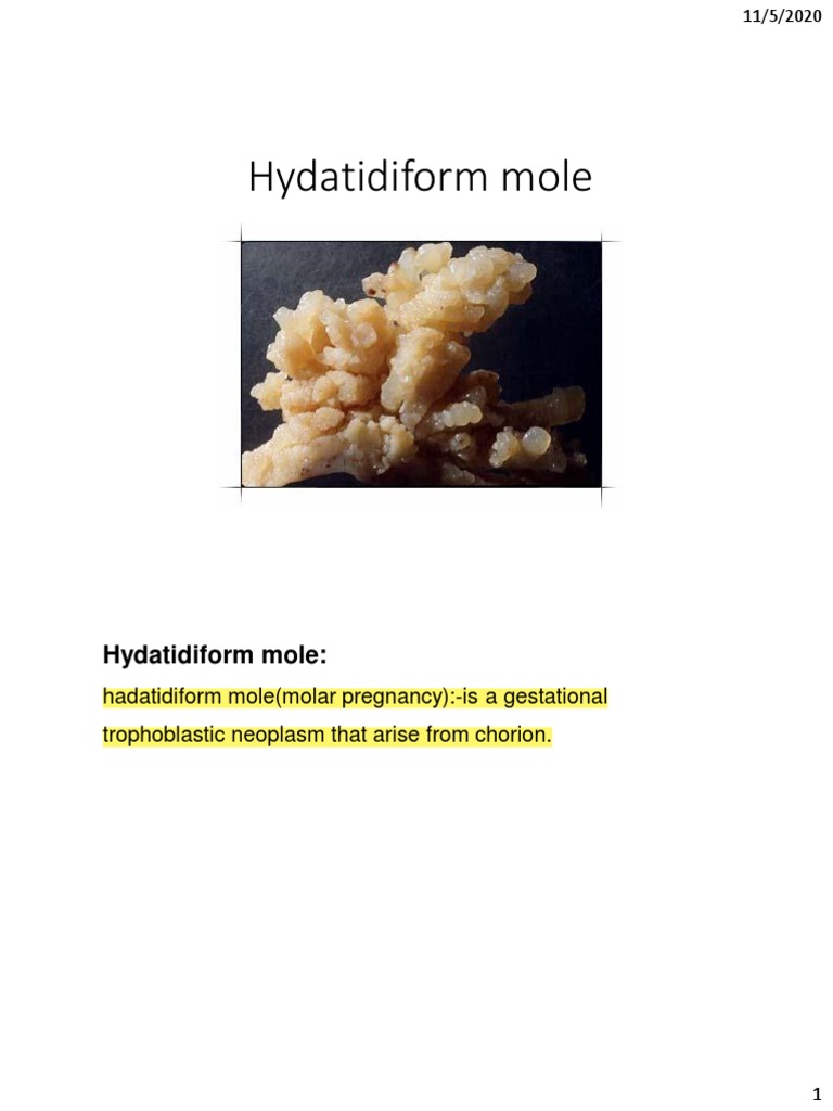 Hydatidiform 4 | PDF | Pregnancy | Health Sciences