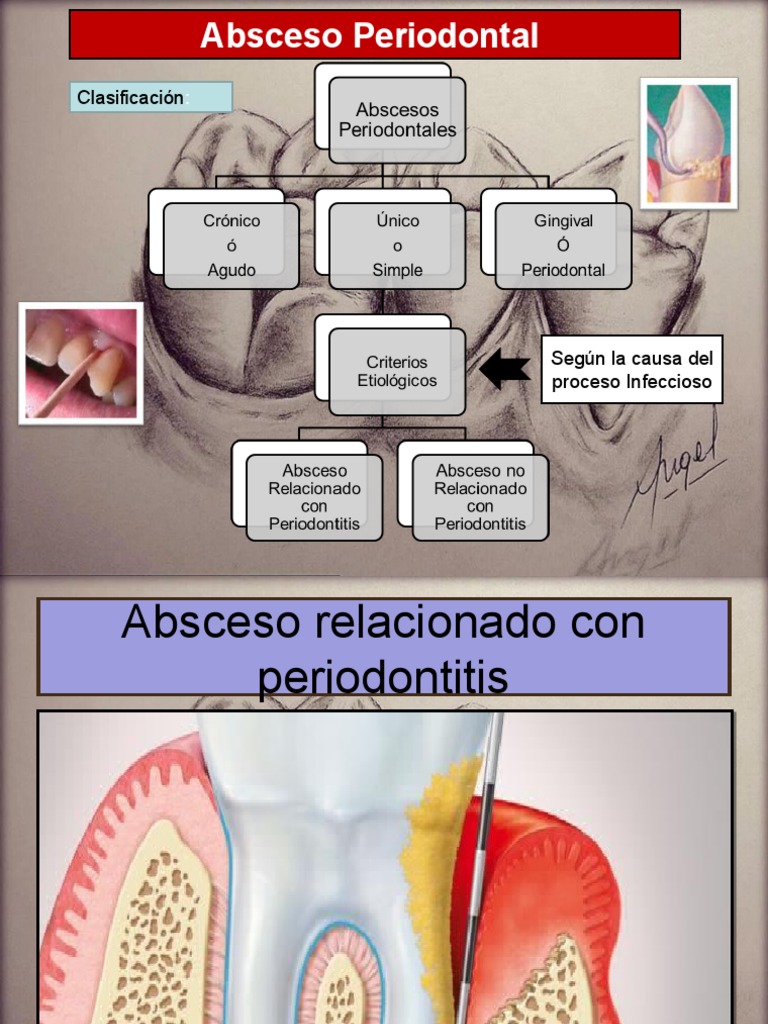 Absceso Periodontal | PDF | Especialidades Medicas | Medicina CLINICA