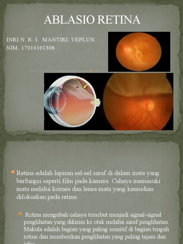 Ablasio Retina | PDF