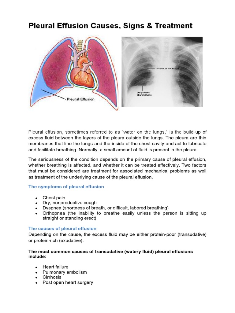 Pleural Effusion Causes, Signs & Treatment | Download Free PDF ...