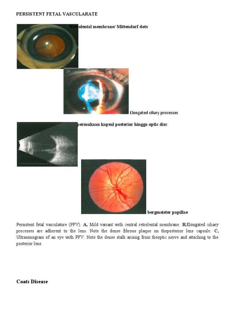PERSISTENT FETAL VASCULARe | PDF