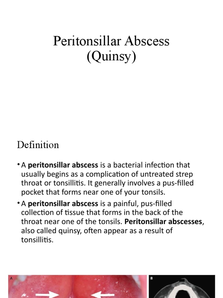 Peritonsillar Abscess (Quinsy) | PDF | Immunology | Medical Specialties