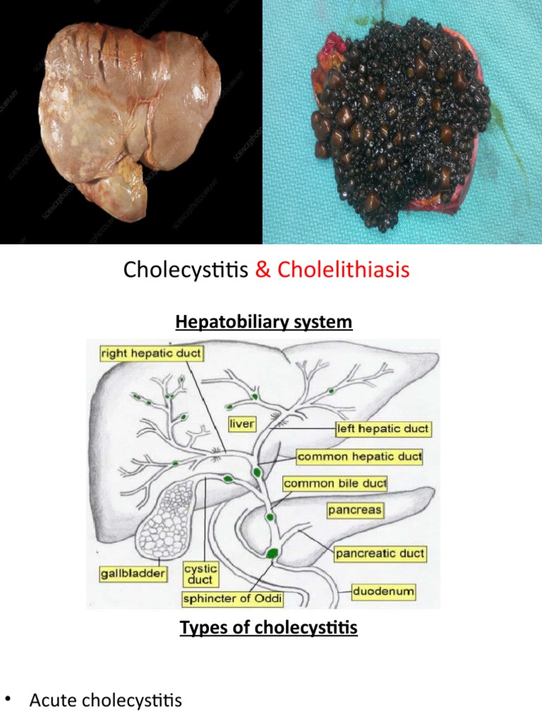 Presentation Cholelithiasis | PDF