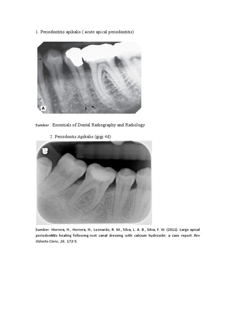 Acute Apical Periodontitis Overview | PDF