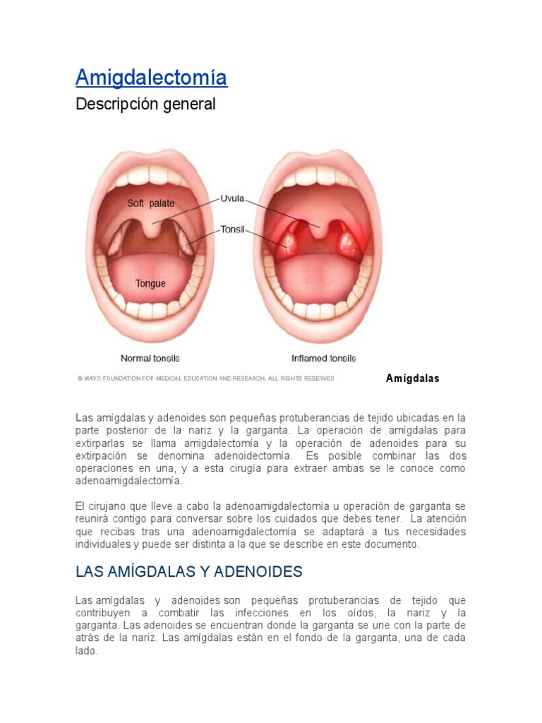 Amigdalectomia | PDF | Sistema inmune | Apnea del sueño