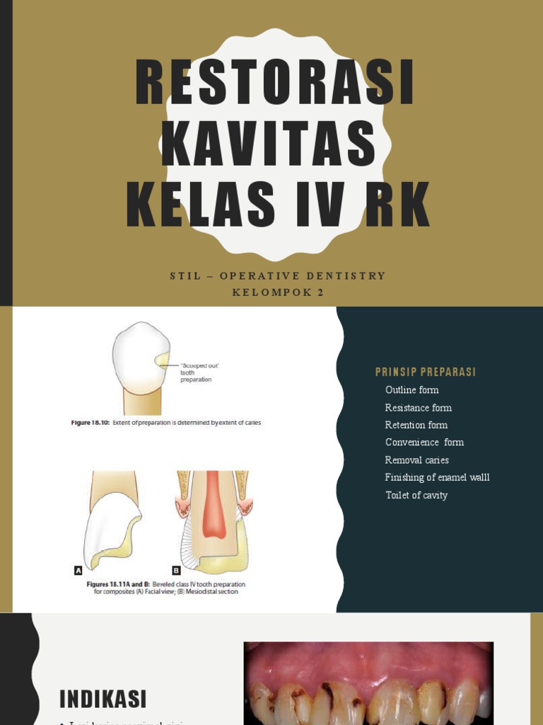 Kavitas Kelas 4 RESIN KOMPOSIT | PDF