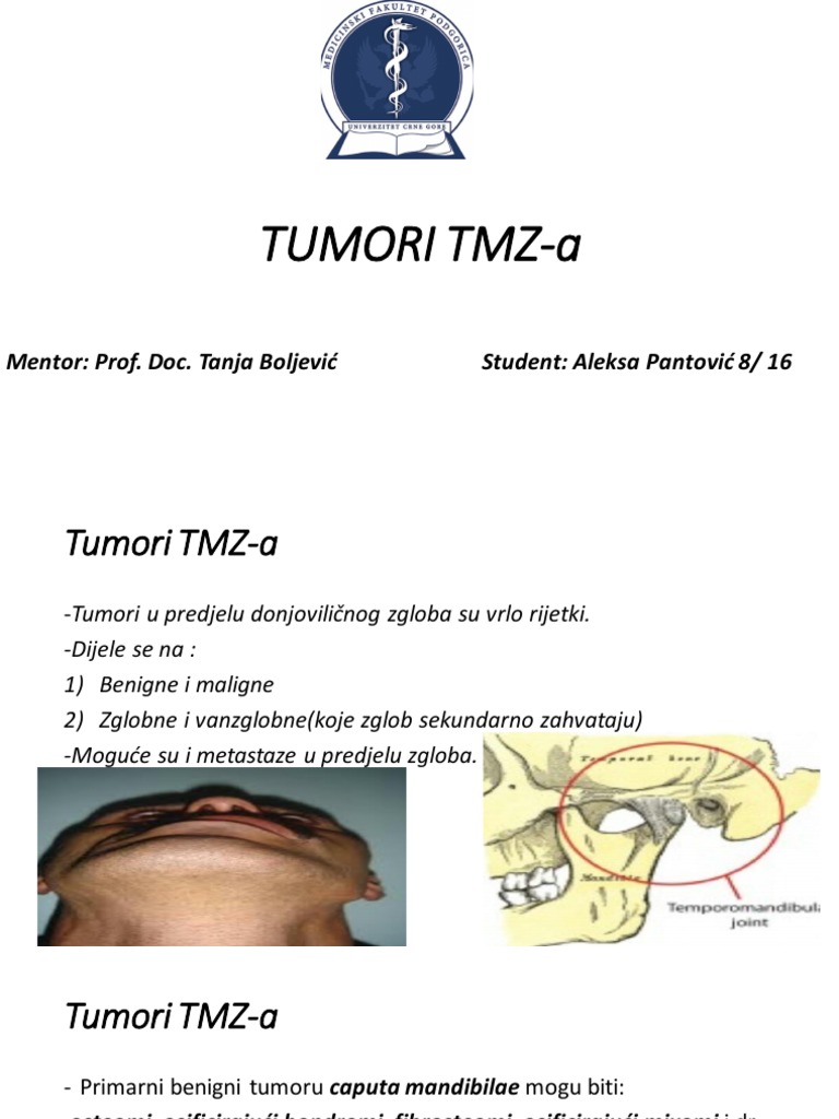 Tumori Tempromandibularnog Zgloba | PDF