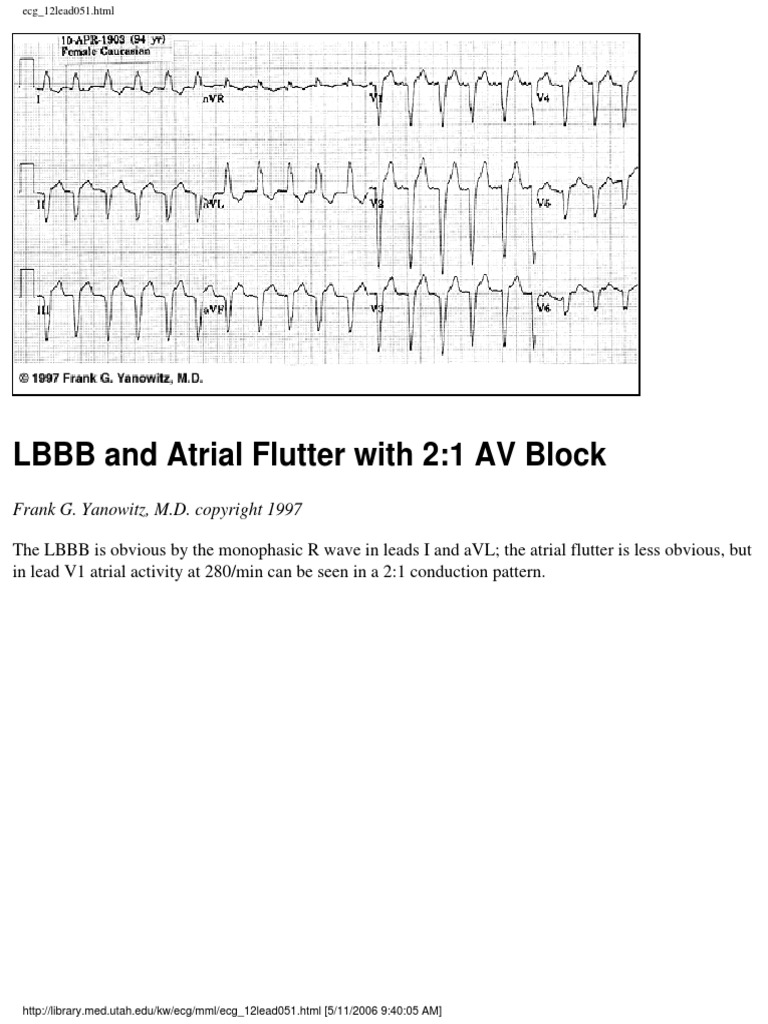 LBBB and Atrial Flutter With 2:1 AV Block | PDF