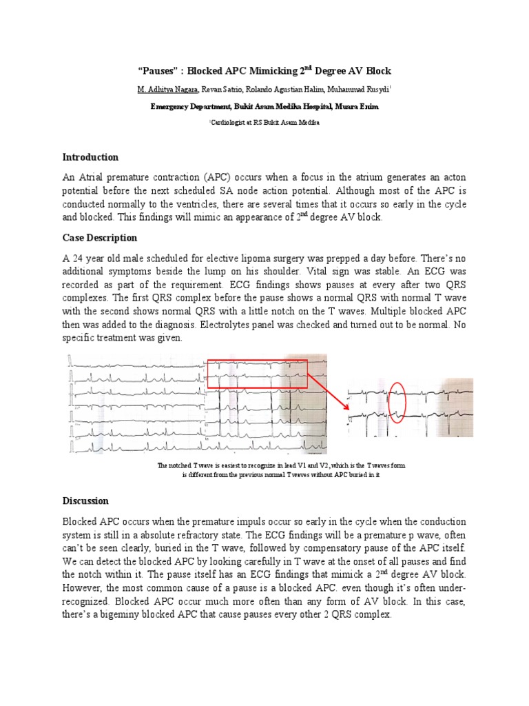 Blocked APC Mimicking 2nd Degree AV Block | PDF