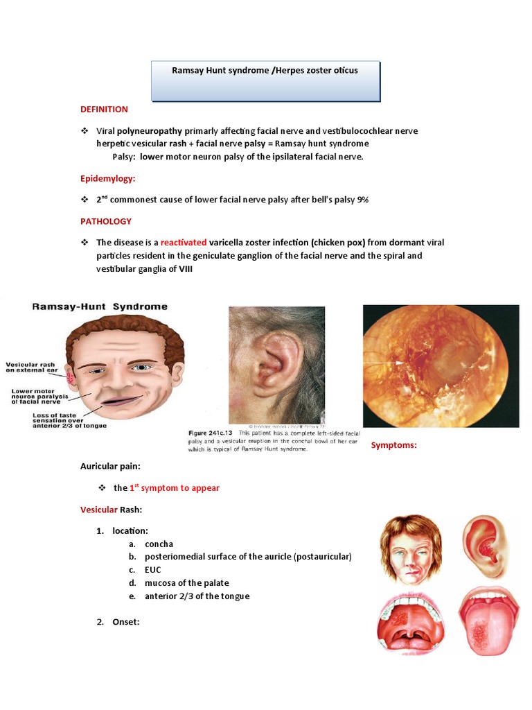Ramsay Hunt Syndrome Ent Pdf Neurology Neurological Disorders