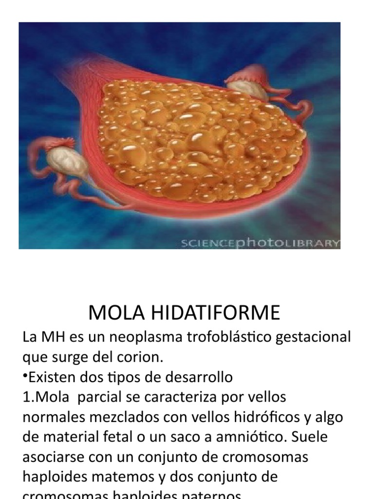 Mola Hidatiforme | PDF | El embarazo | Gonadotropina coriónica humana