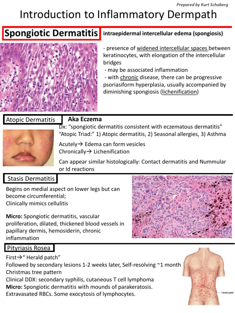 Spongiotic Dermatitis Overview | PDF | Dermatitis | Epidermis