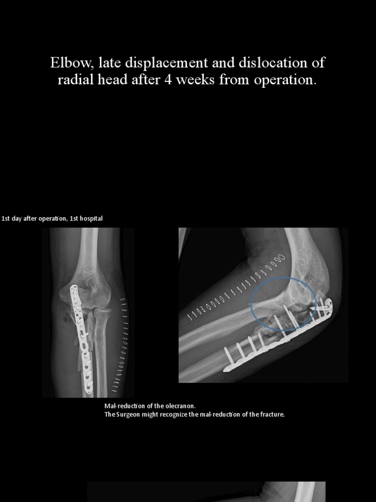 Radial Head Dislocation Post-Operation Analysis | PDF