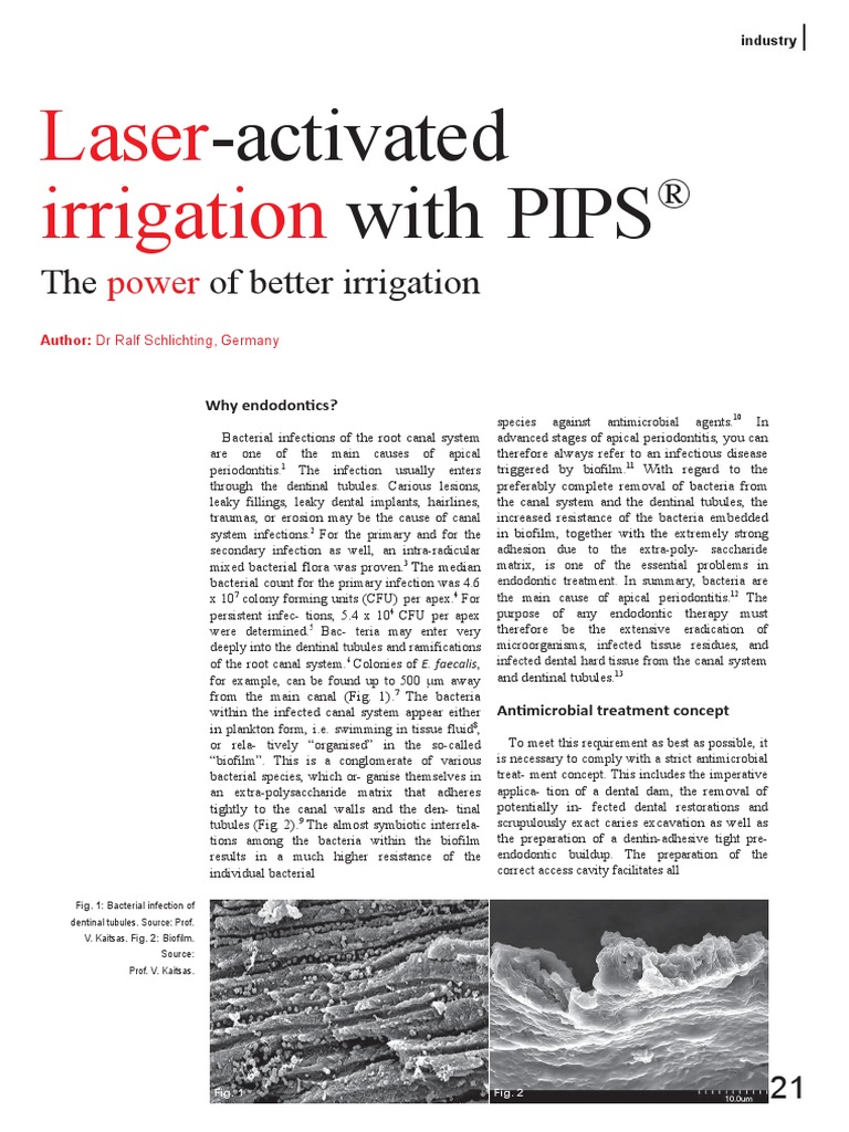 Activated With PIPS: Laser Irrigation | PDF | Laser | Biofilm