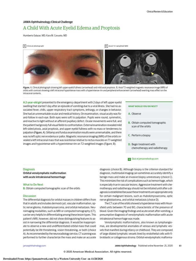 A Child With Acute Eyelid Edema and Proptosis: JAMA Ophthalmology ...