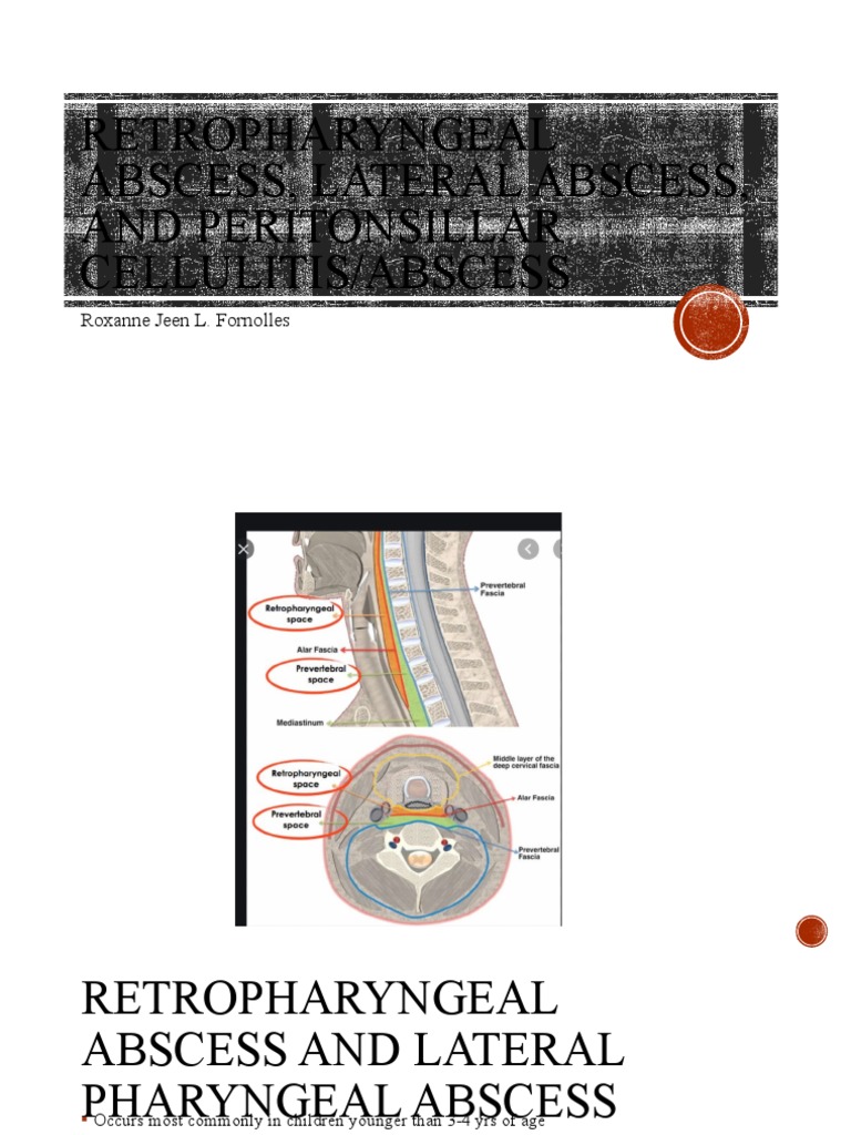 Retropharyngeal Abscess Report | PDF | Larynx | Pneumonia