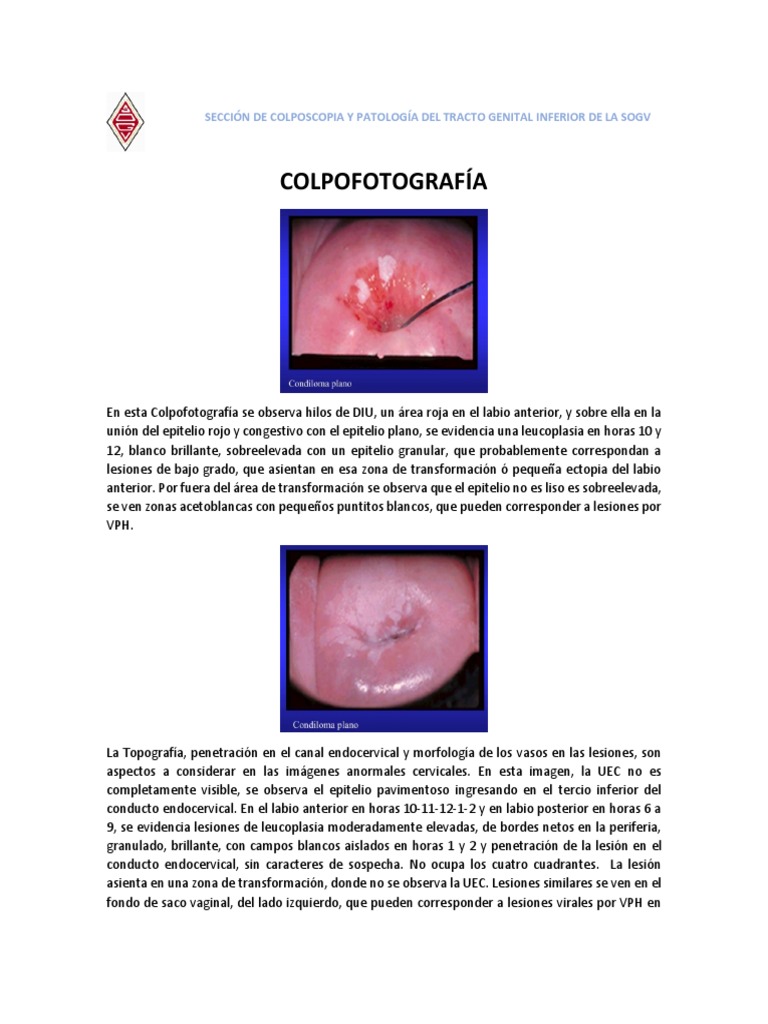 Colposcopía: Imágenes de ectopias, lesiones y hallazgos normales | PDF ...
