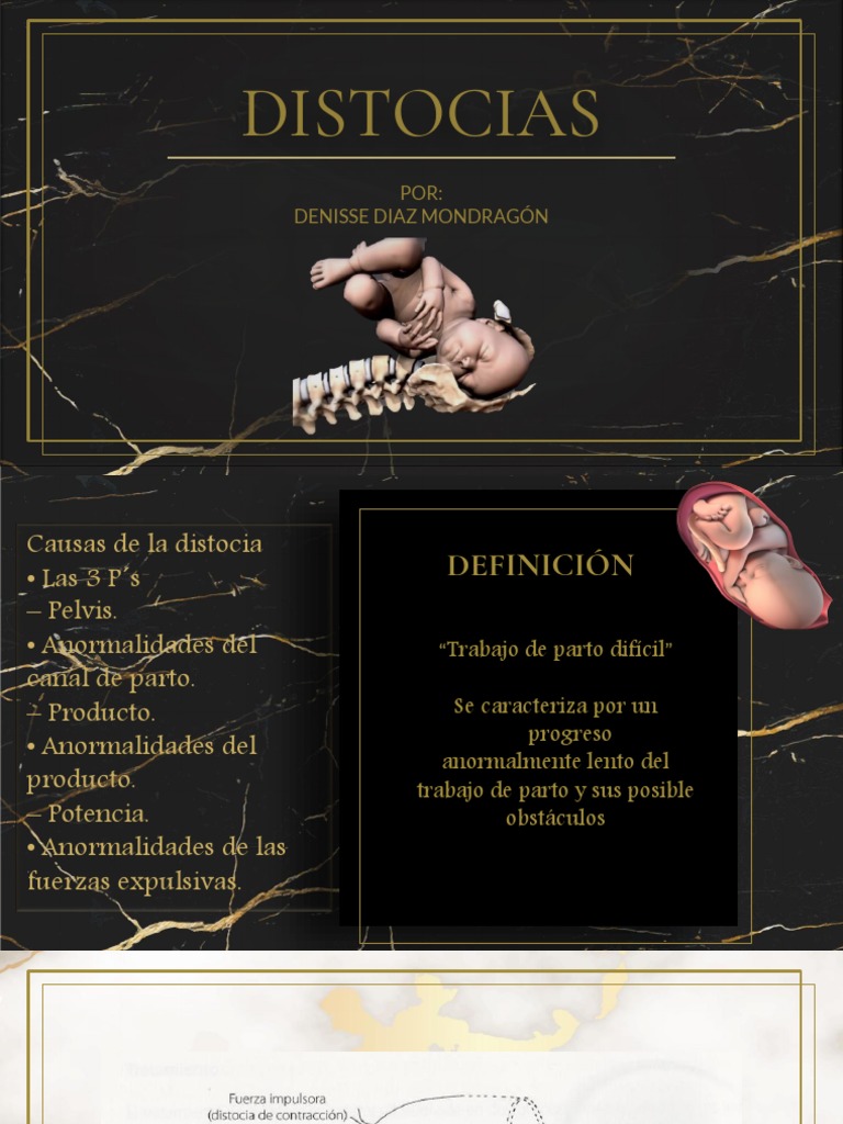 Distocias Materno Fetales | PDF | Parto | Pelvis