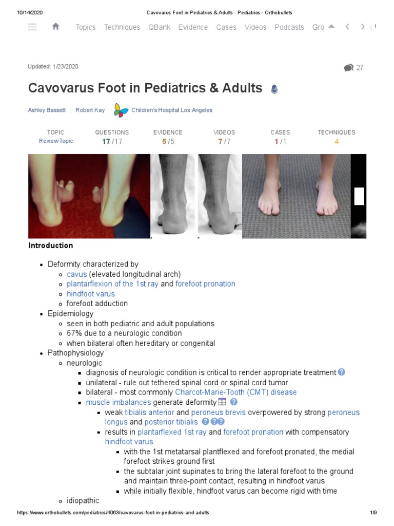 Cavovarus Foot in Pediatrics & Adults - Pediatrics - Orthobullets ...