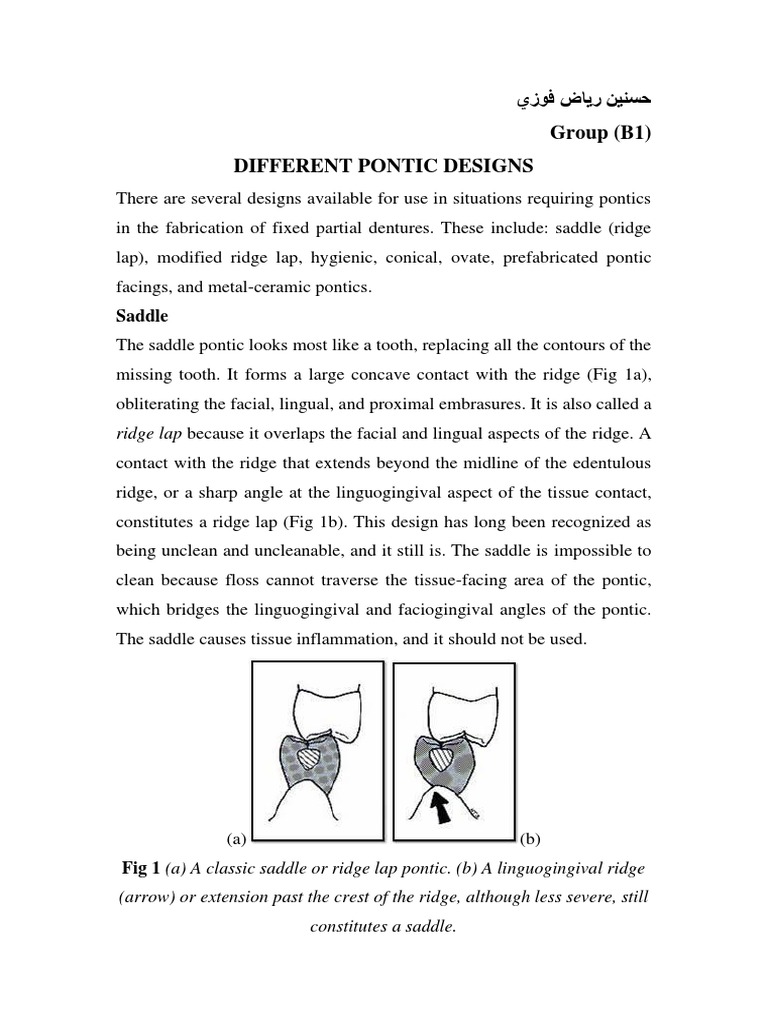 Different Pontic Design | PDF | Dentures | Mouth