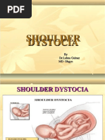 Zavanelli Maneuver for Shoulder Dystocia | PDF | Childbirth | Caesarean ...