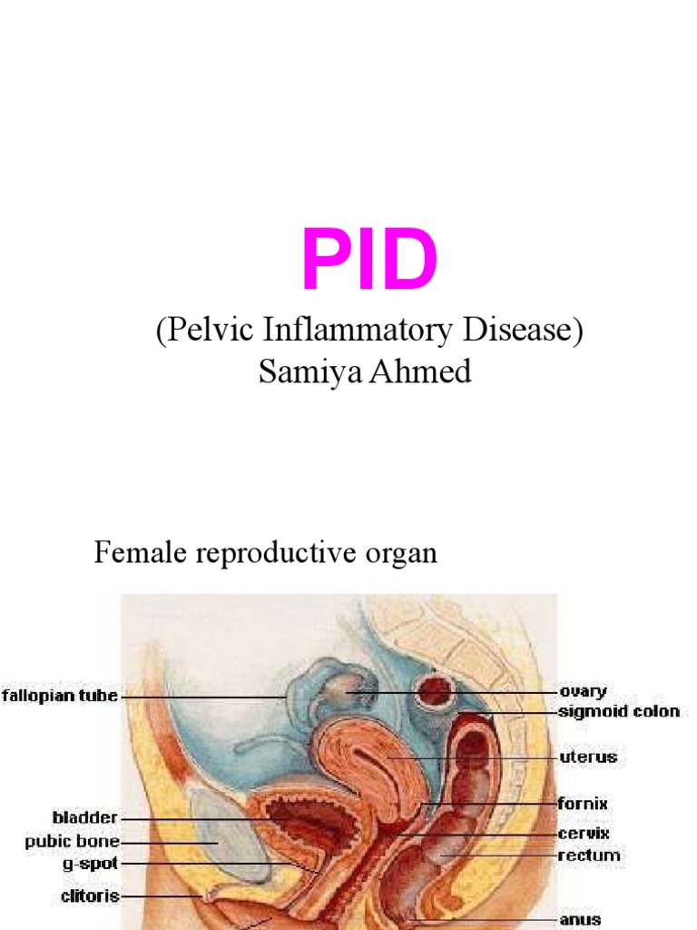 (Pelvic Inflammatory Disease) Samiya Ahmed | PDF | Human Reproduction ...
