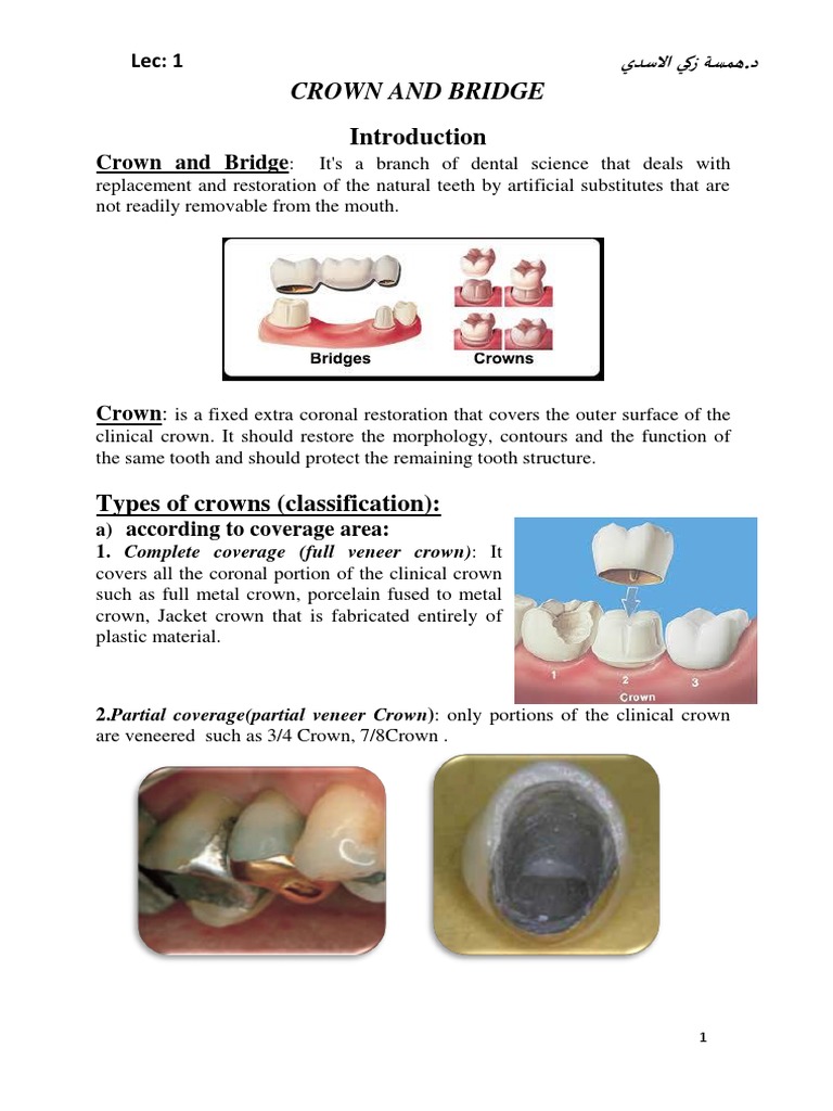 Crown and Bridge: A) 1. Complete Coverage (Full Veneer Crown) : It ...