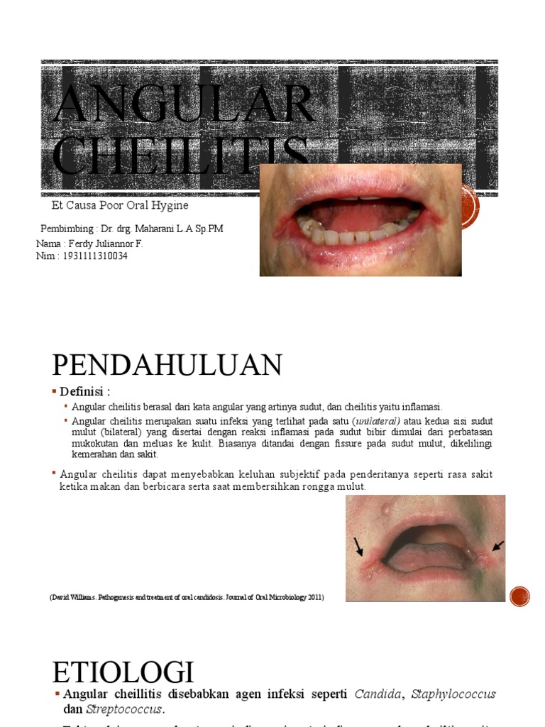 Perawatan dan Penyebab Angular Cheilitis | PDF