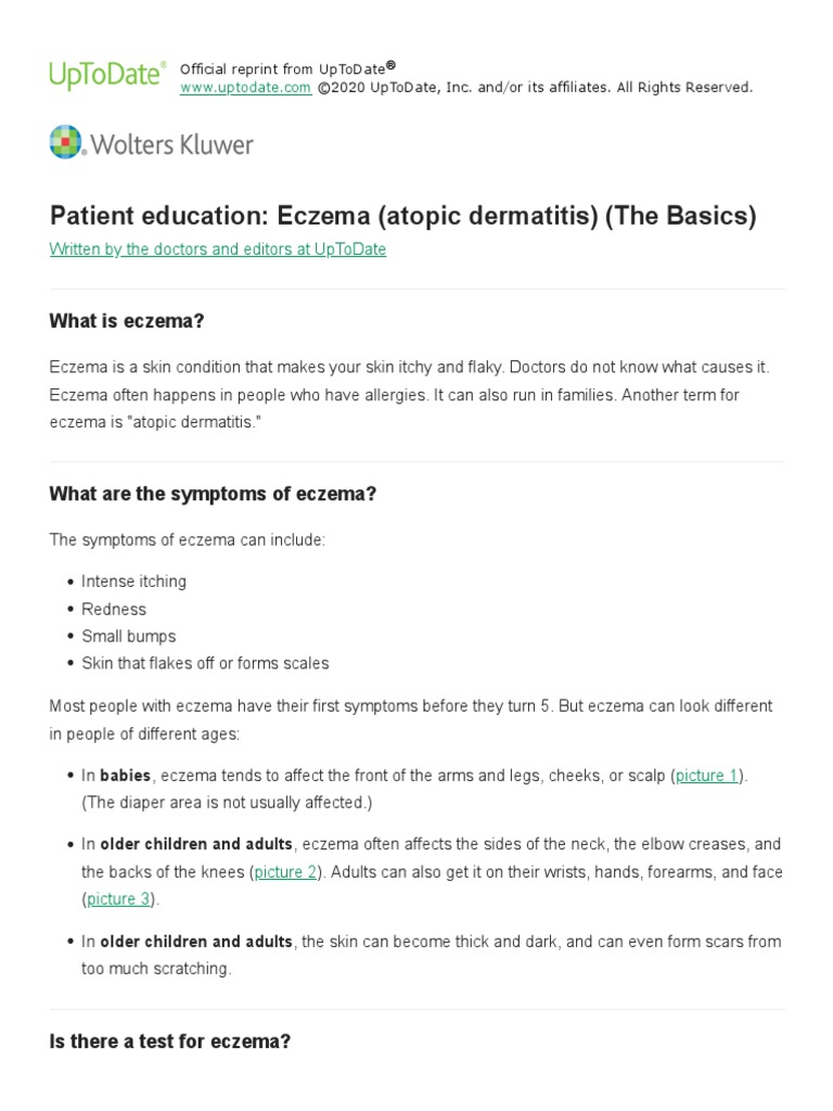 Patient Education - Eczema (Atopic Dermatitis) (The Basics) - UpToDate ...