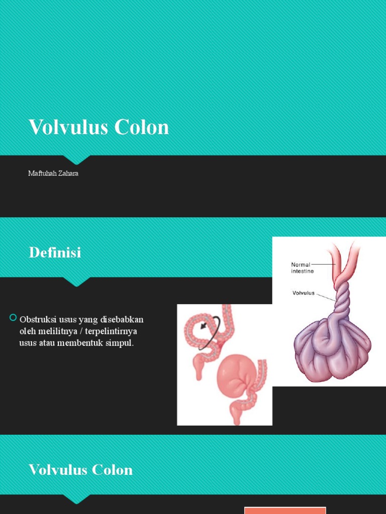Volvulus Colon | PDF