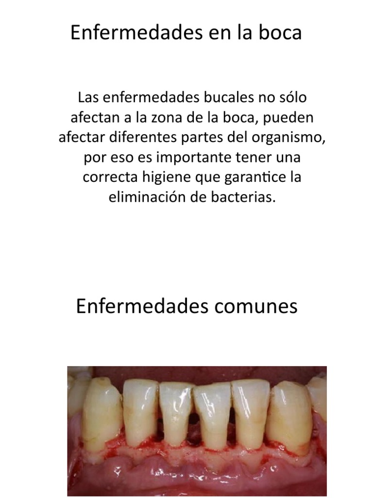 Enfermedades en La Boca | PDF | Herpes Simple | Odontología