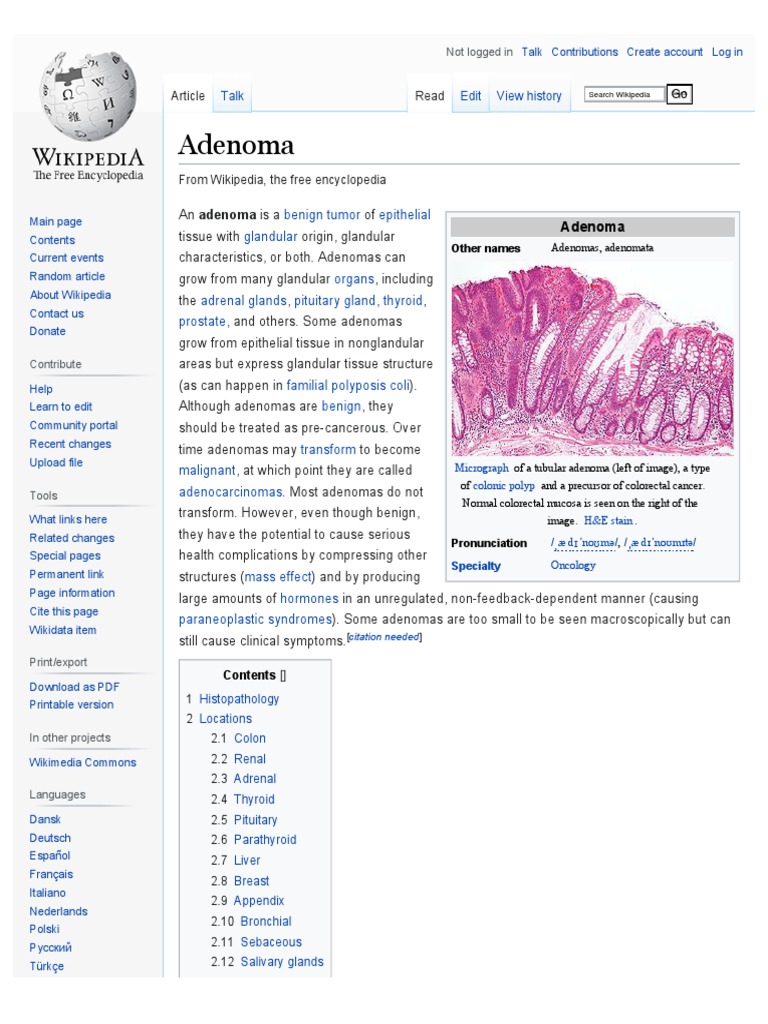 Adenoma: Benign Tumor Epithelial Glandular Organs Adrenal Glands ...
