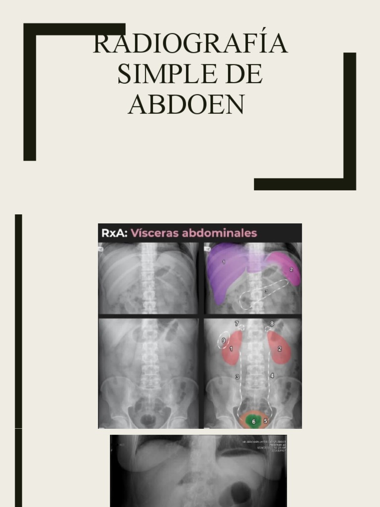 Radiografía Simple de Abdomen | PDF
