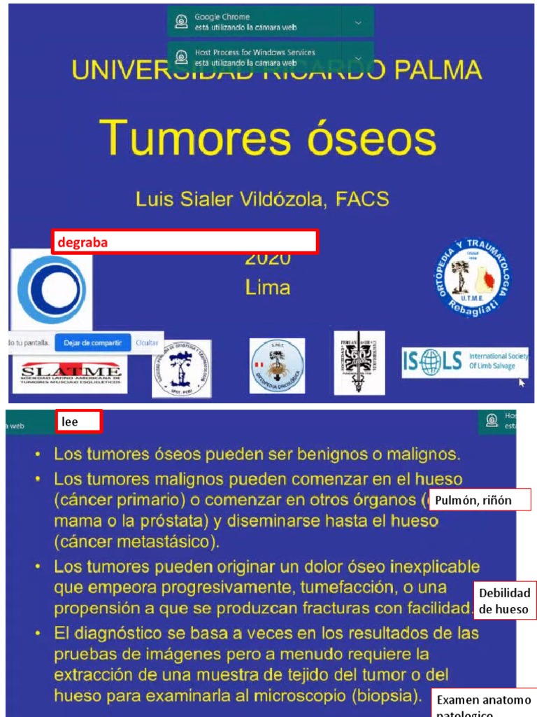 Tumores Oseos Benignos | PDF | Cáncer | Neoplasias