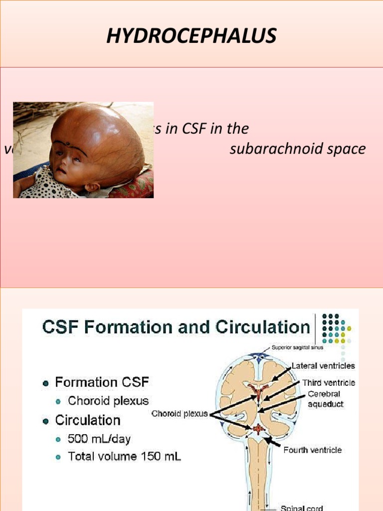 Hydrocephalus Hydrocephalus: - An Excess in CSF in The - An Excess in ...