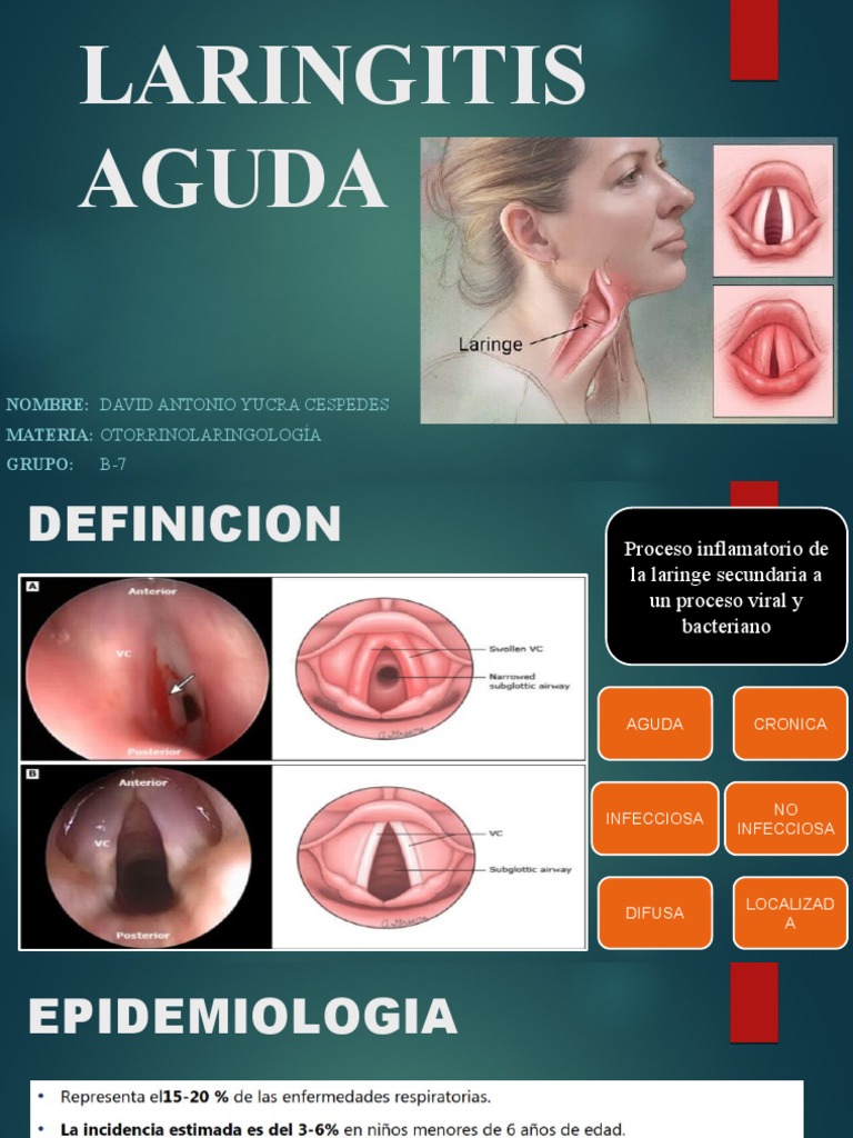 Laringitis Aguda 2020 | PDF