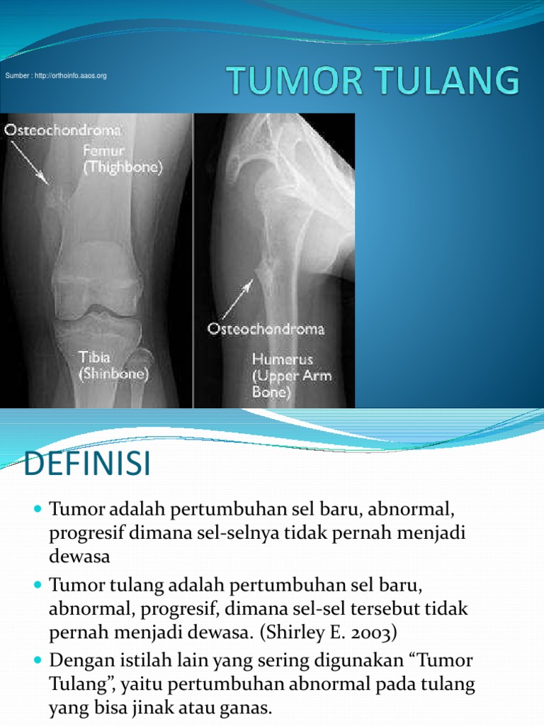 Tumor Tulang: Definisi dan Penanganan | PDF