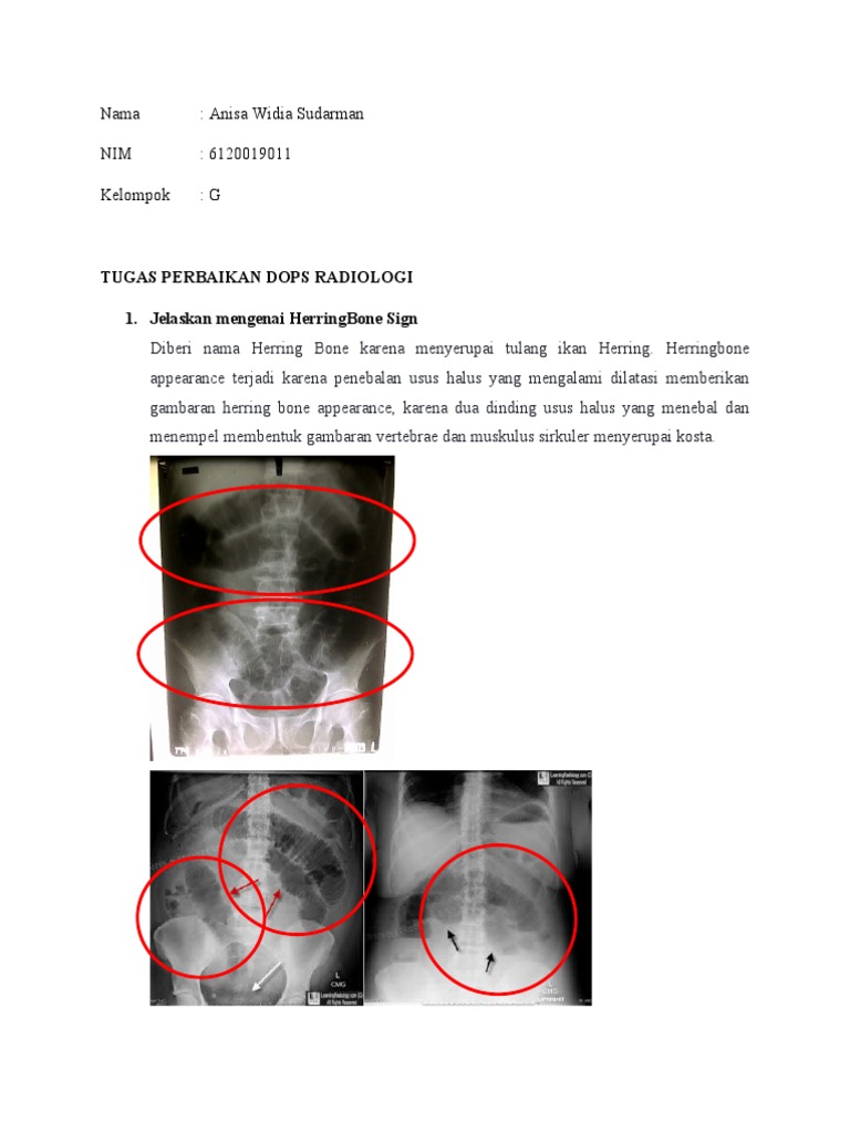 Herring Bone Sign dalam Radiologi | PDF | Ilmu Sosial