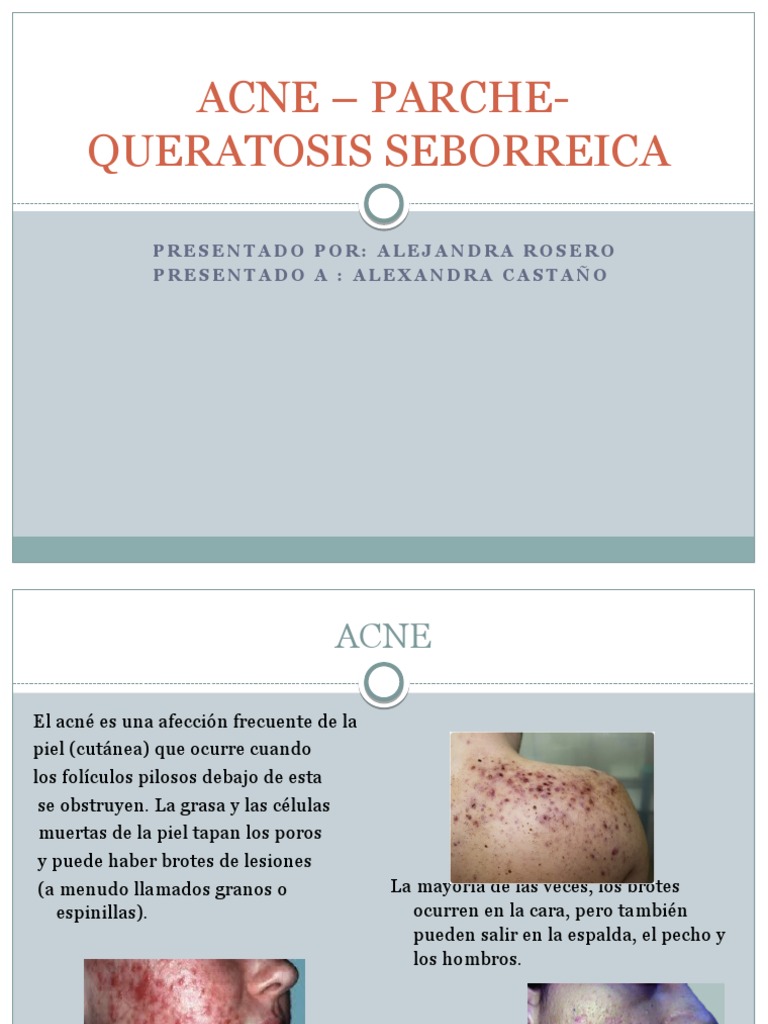 Acne Queratosis Seborreica | PDF | Piel | Productos cosméticos