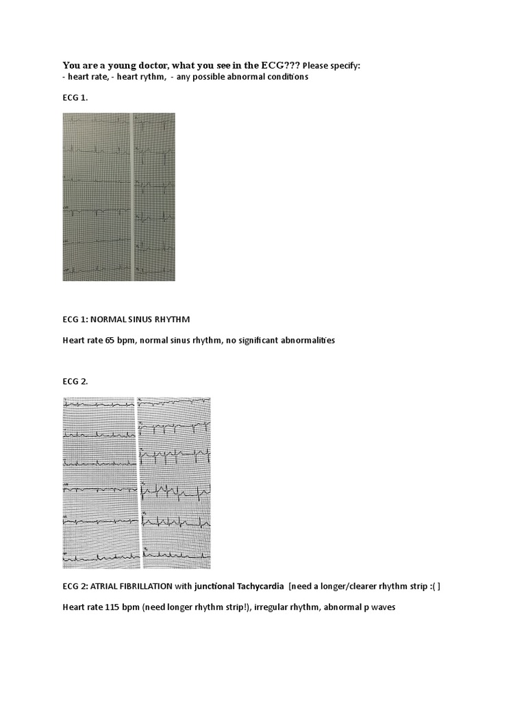 ECG Analysis and Decision Tree Guide | PDF