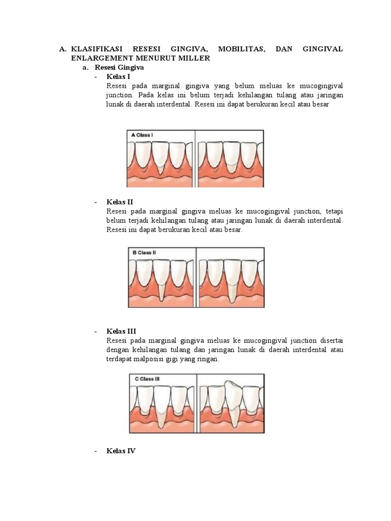 Klasifikasi Resesi Gingiva Menurut Miller | PDF