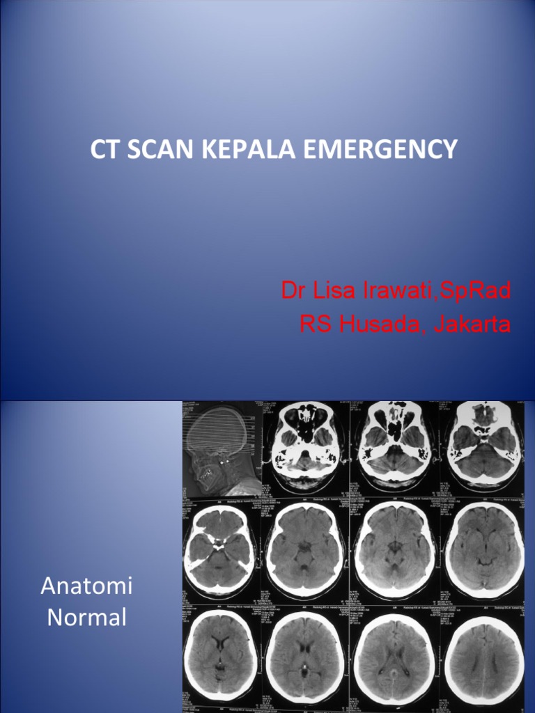 Gambaran CT Scan Kepala Normal dan Lesi | PDF