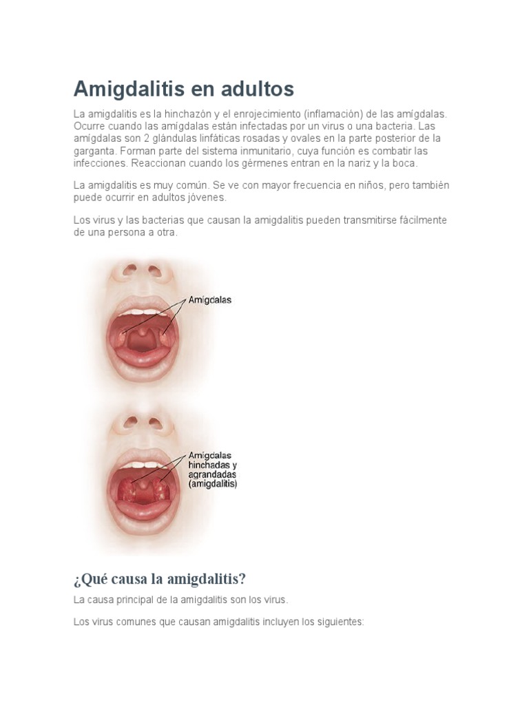 Amigdalitis en Adultos | PDF | Virus | Salud pública